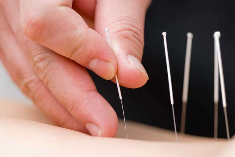 First Micro Acupuncture 48 Training Certification – AcuVision Acupuncture!