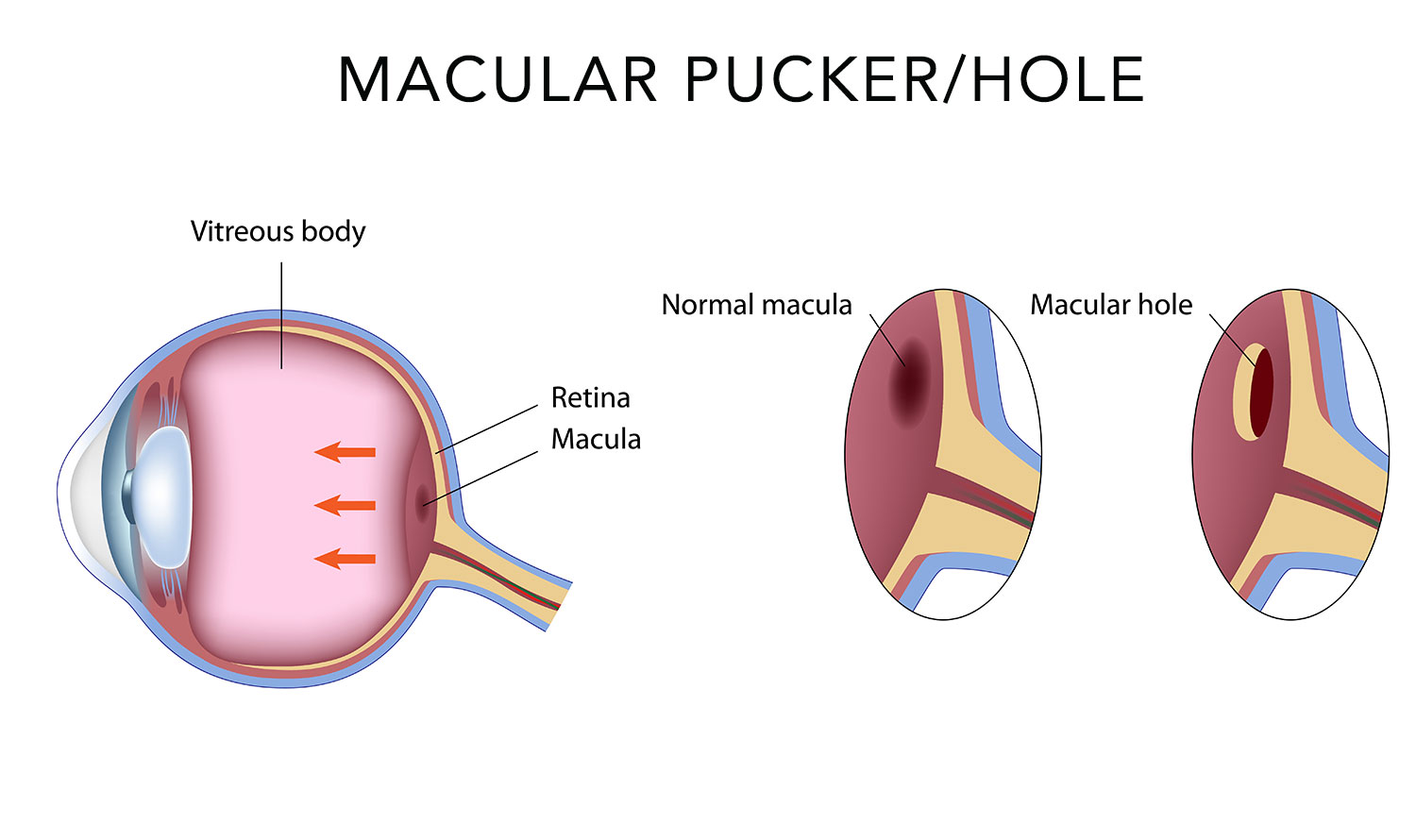 Macular Pucker