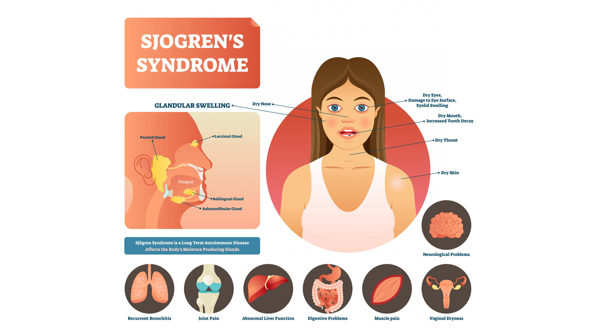 Sjogren's Syndrome - AcuVision Acupuncture!
